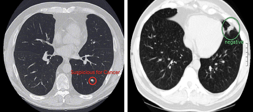 Google’s lung cancer detection AI outperforms 6 human radiologists ...